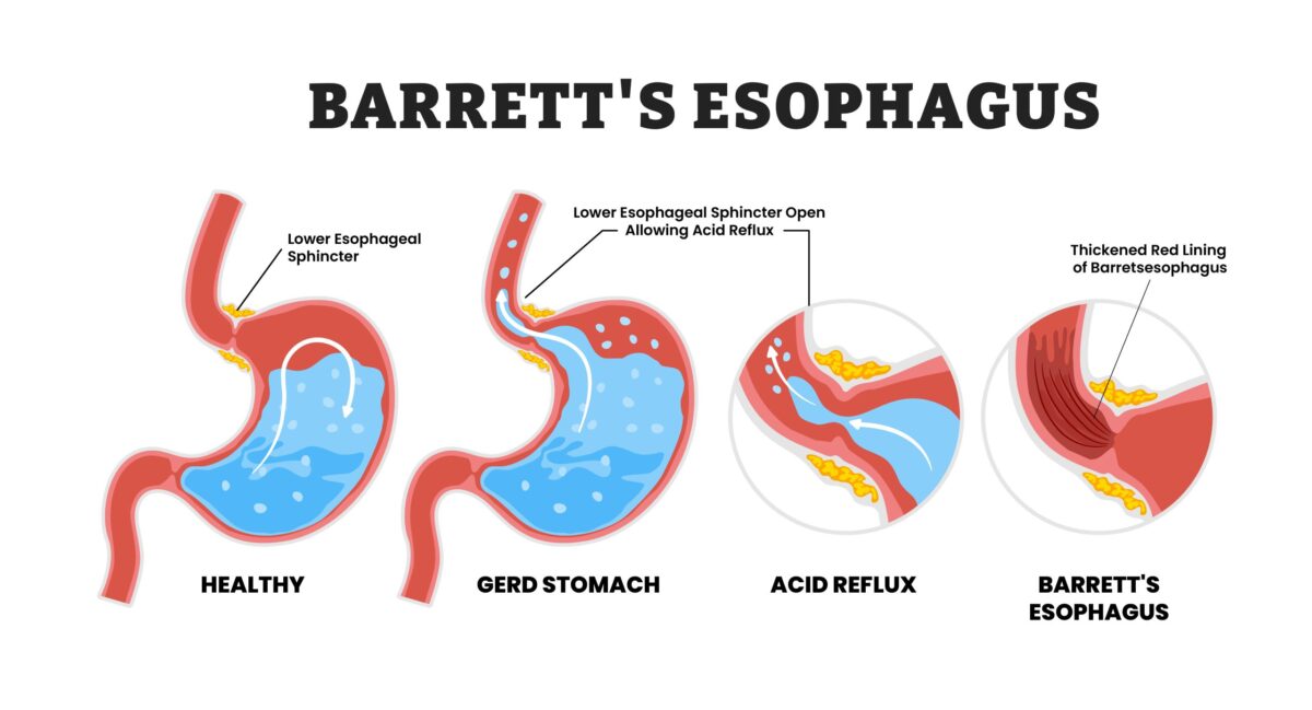 Barrett’s Esophagus Treatment in Reno, NV | GI Consultants